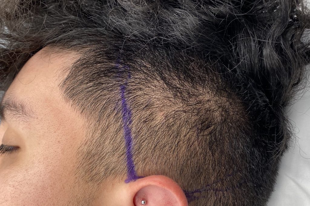 Plastic Surgery Case Study - Temporal Reduction Side of the Head ...