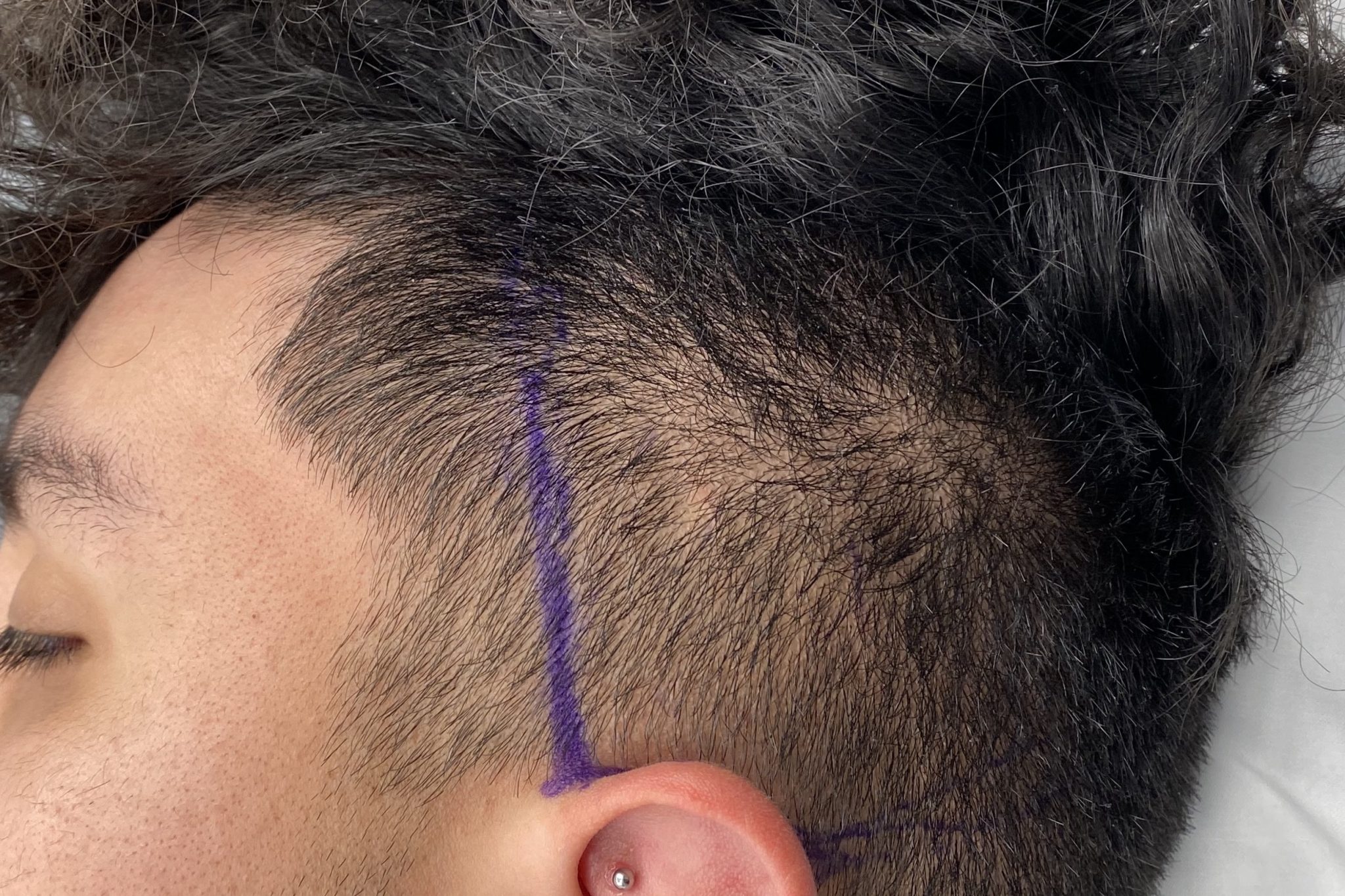 Plastic Surgery Case Study - Temporal Reduction Side of the Head ...