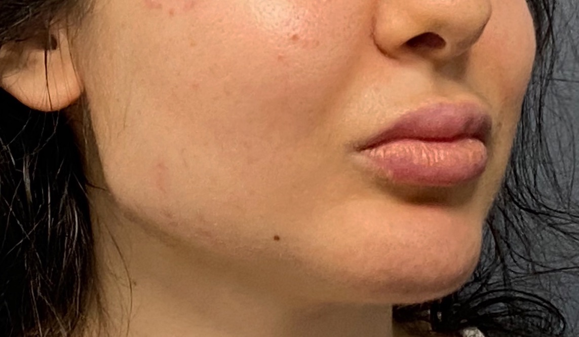 Plastic Surgery Case Study - Female Vertical Lengthening Jaw Angle ...