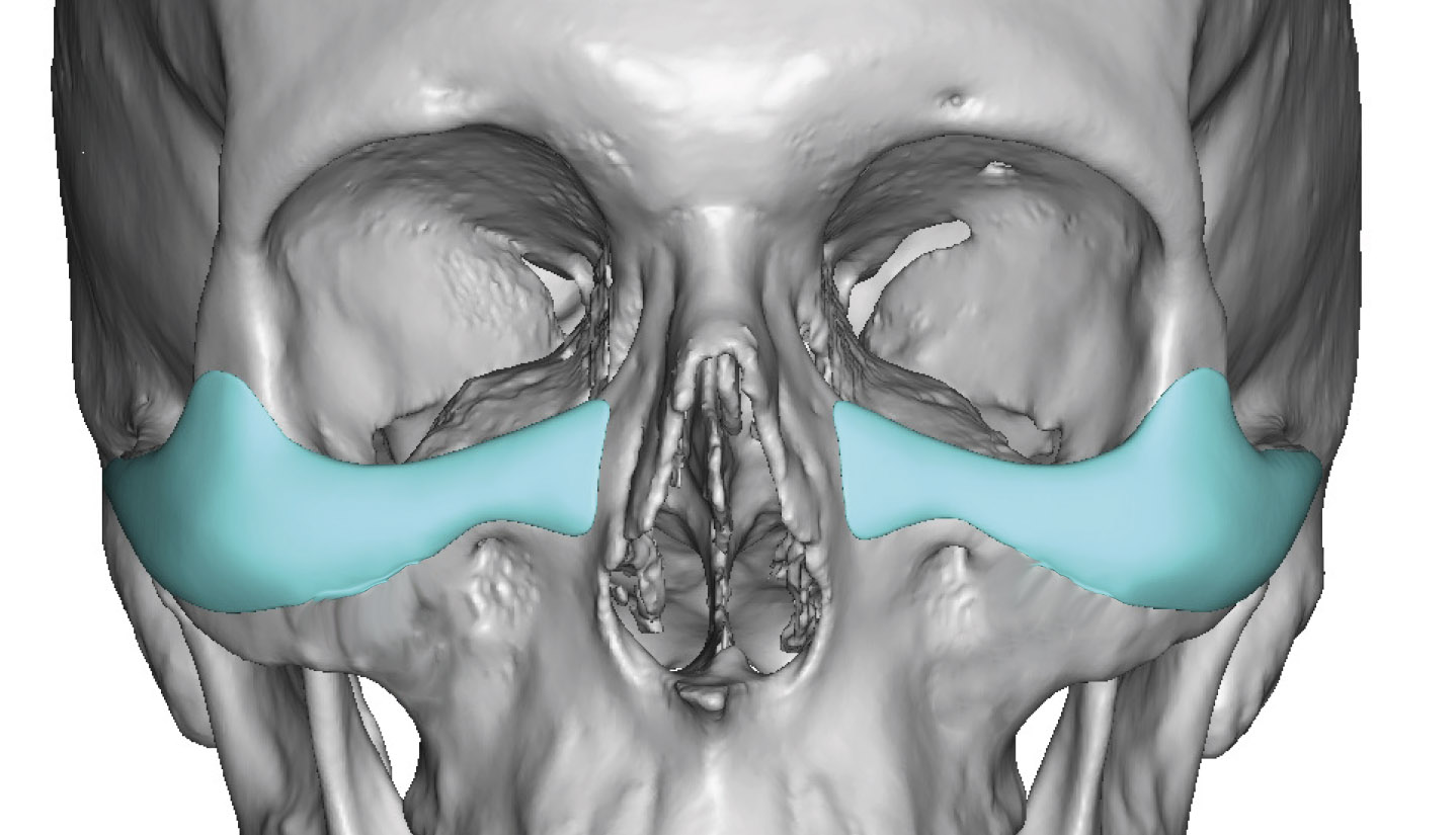 custom aesthetic infraorbital-malar implant designs 2 Dr Barry Eppley ...