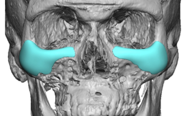 Custom Implant Design Possibilities for the Treatment of Undereye ...