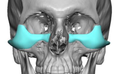 custom large infraornital-malar implant design DR Barry Eppley ...