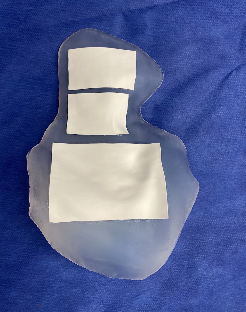 Plastic Surgery Case Study - Custom Chest Wall Implant for Ribcage and ...