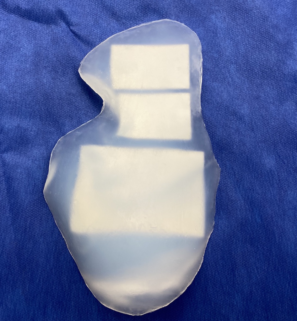 Plastic Surgery Case Study - Custom Chest Wall Implant for Ribcage and ...