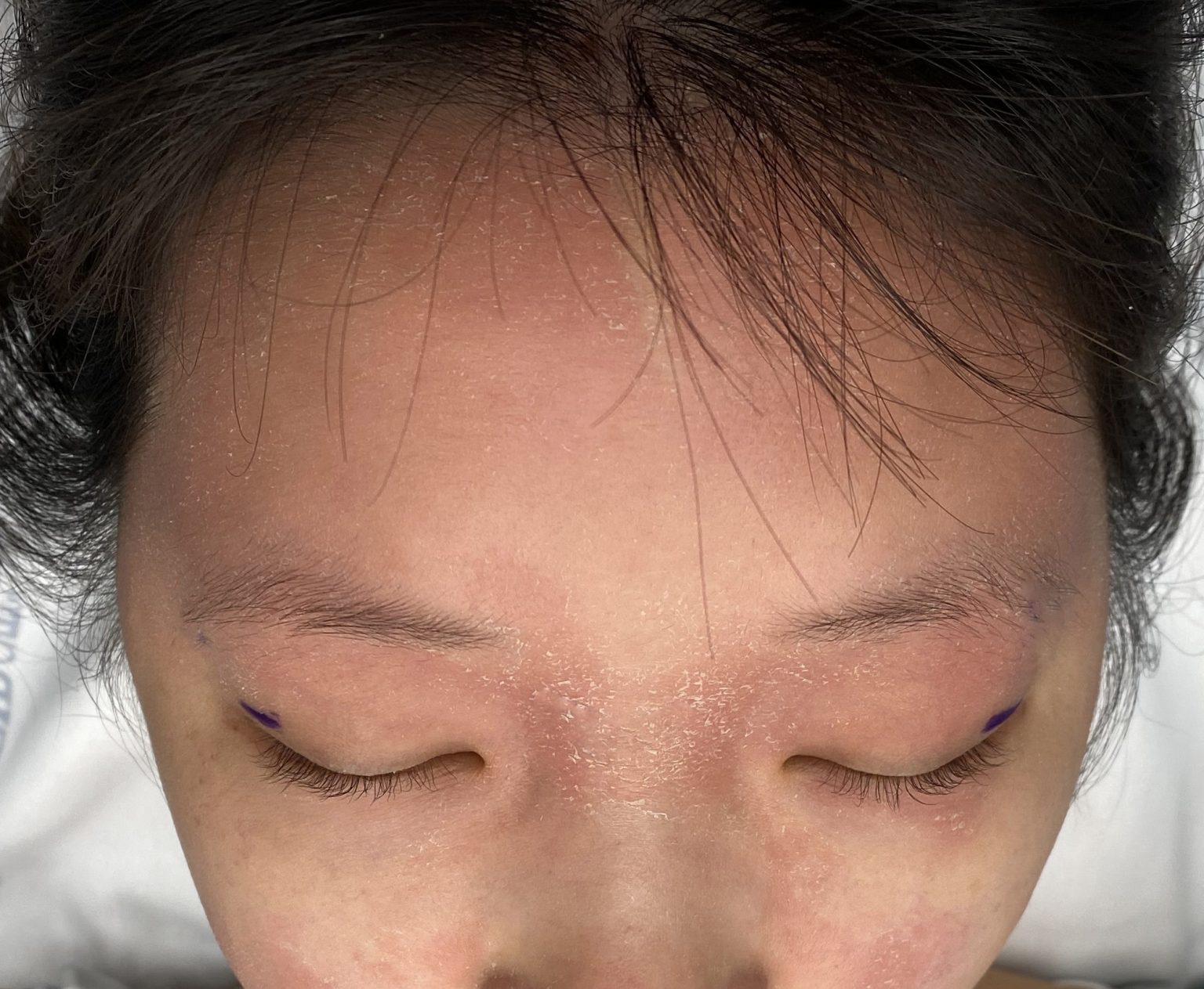 Plastic Surgery Case Study - Female Custom Brow Bone Implant for ...