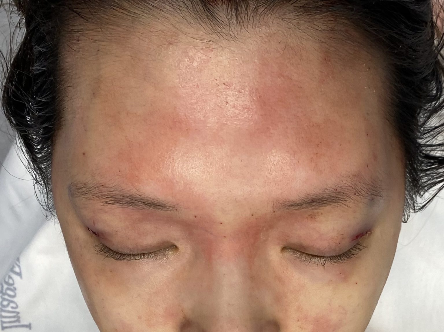 Plastic Surgery Case Study - Female Custom Brow Bone Implant for ...