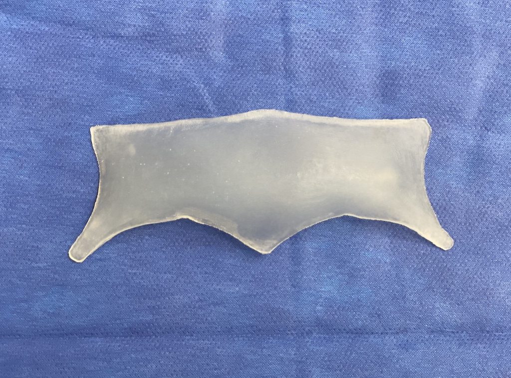 female custom brow bone implant intraop Dr Barry Eppley Indianapolis ...