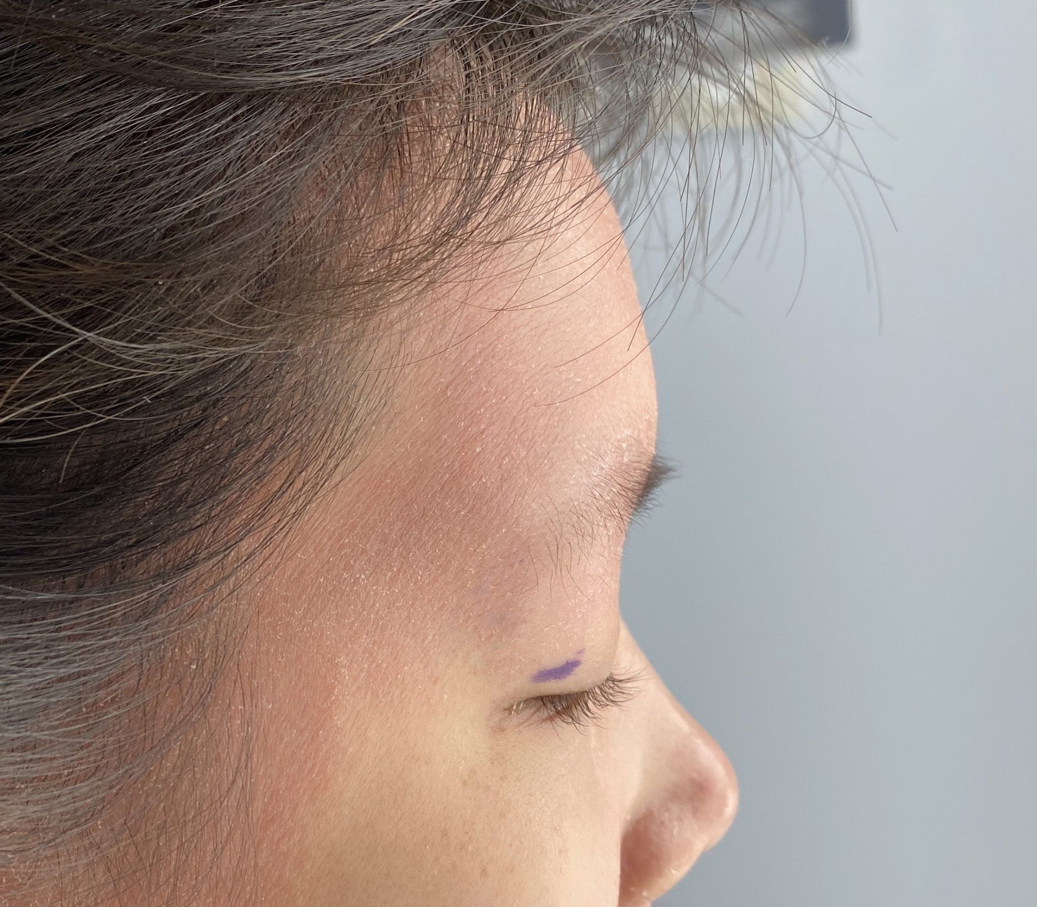 female custom brow bone implant side 1 Dr Barry Eppley Indianapolis ...