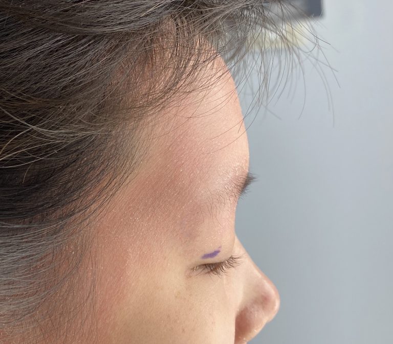 Plastic Surgery Case Study - Female Custom Brow Bone Implant for ...