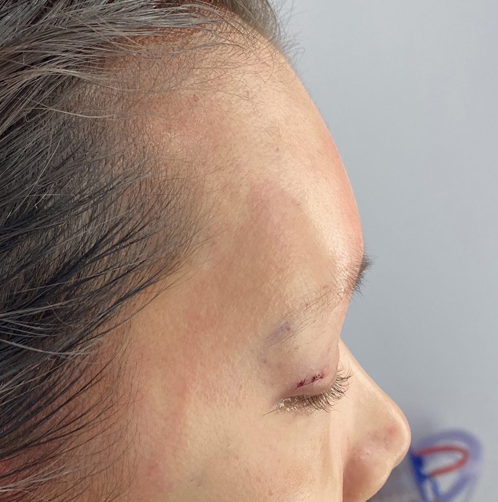 female custom brow bone implant side 2 Dr Barry Eppley Indianapolis ...