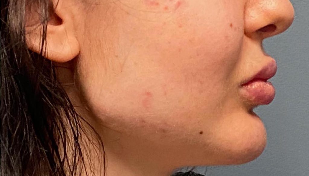 Plastic Surgery Case Study - Female Vertical Lengthening Jaw Angle ...