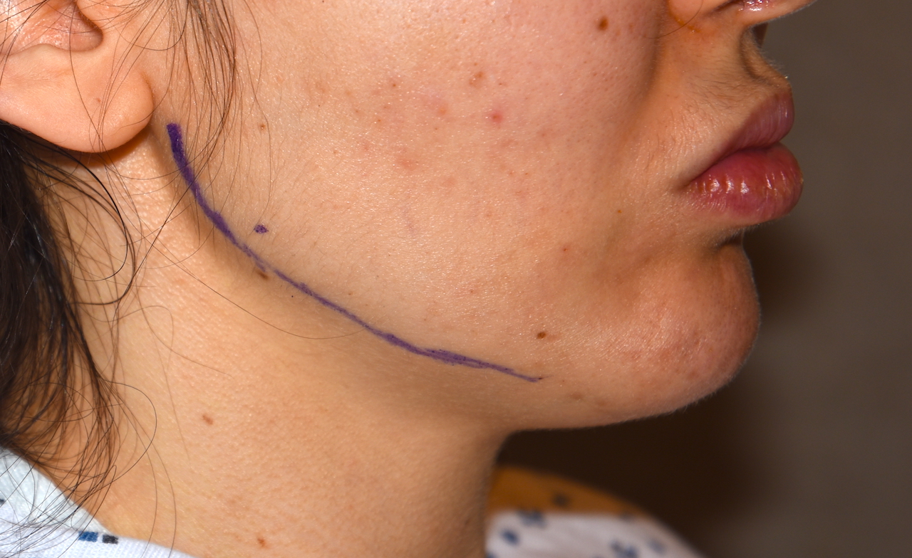Plastic Surgery Case Study - Female Vertical Lengthening Jaw Angle ...