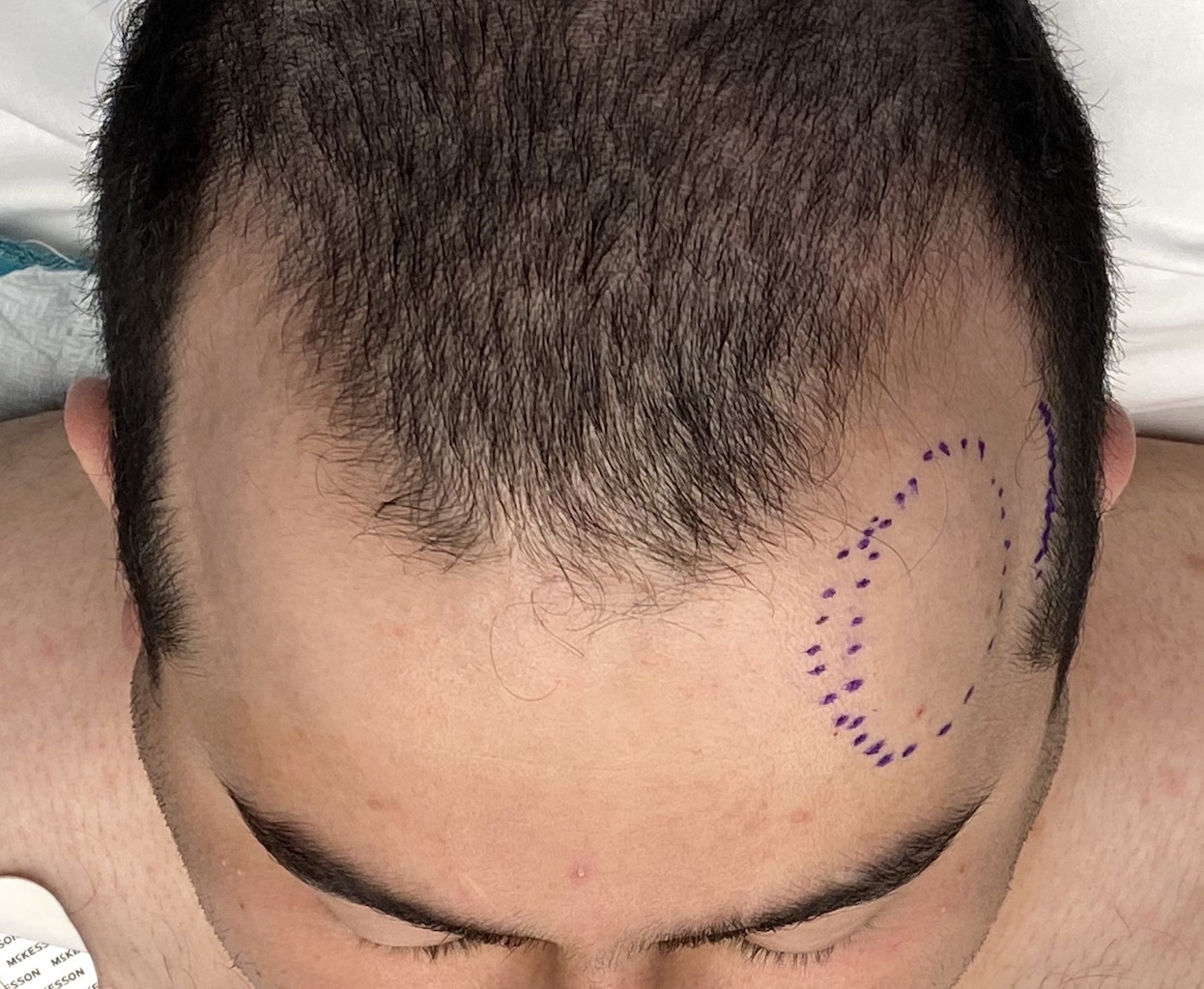 Plastic Surgery Case Study - Limited Incision Technique in Forehead ...