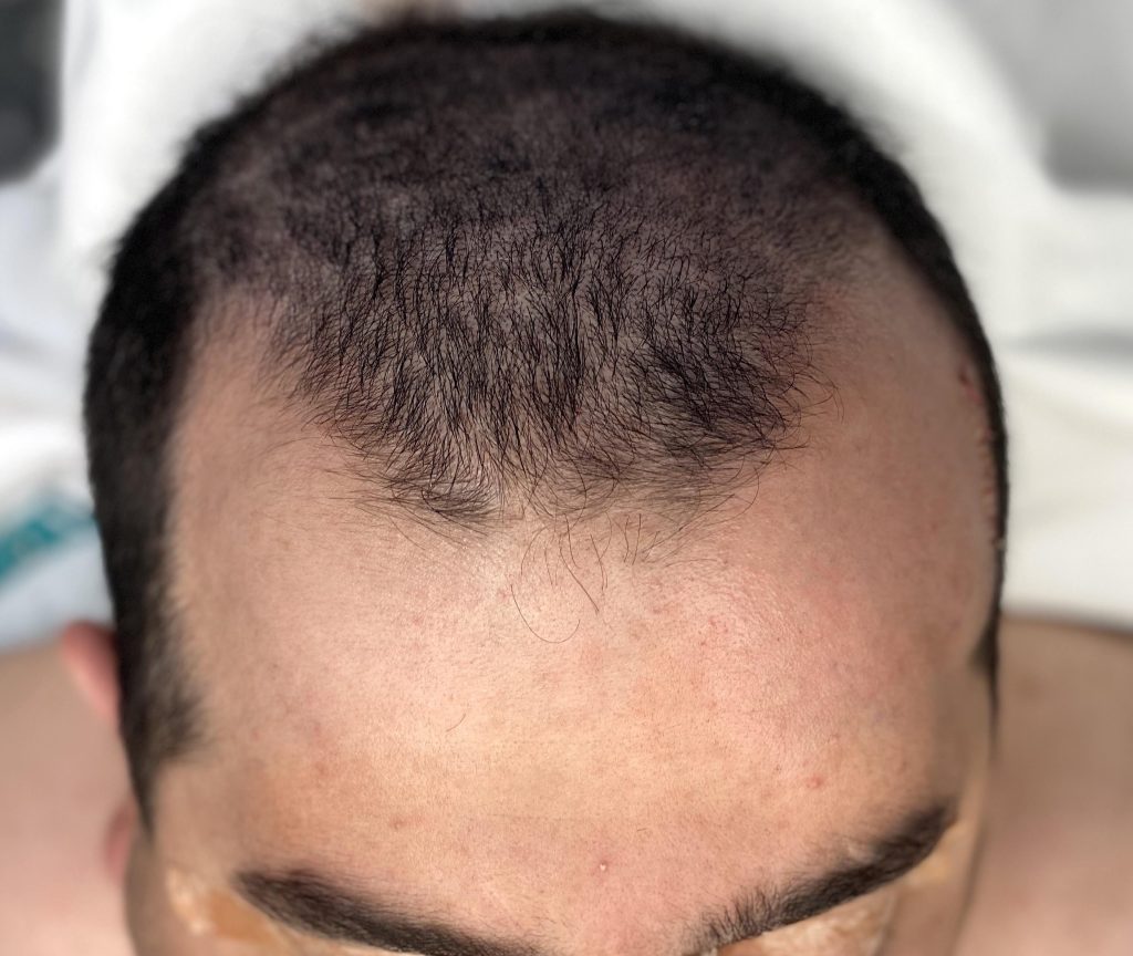 Plastic Surgery Case Study - Limited Incision Technique in Forehead ...