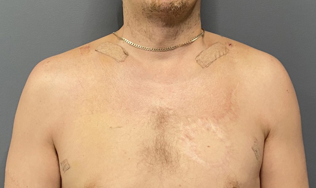 Plastic Surgery Case Study - Male Clavicle Lengthening (Shoulder ...