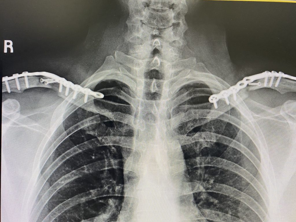 male clavicle lengthening postop x-ray Dr Barry Eppley Indianapolis ...