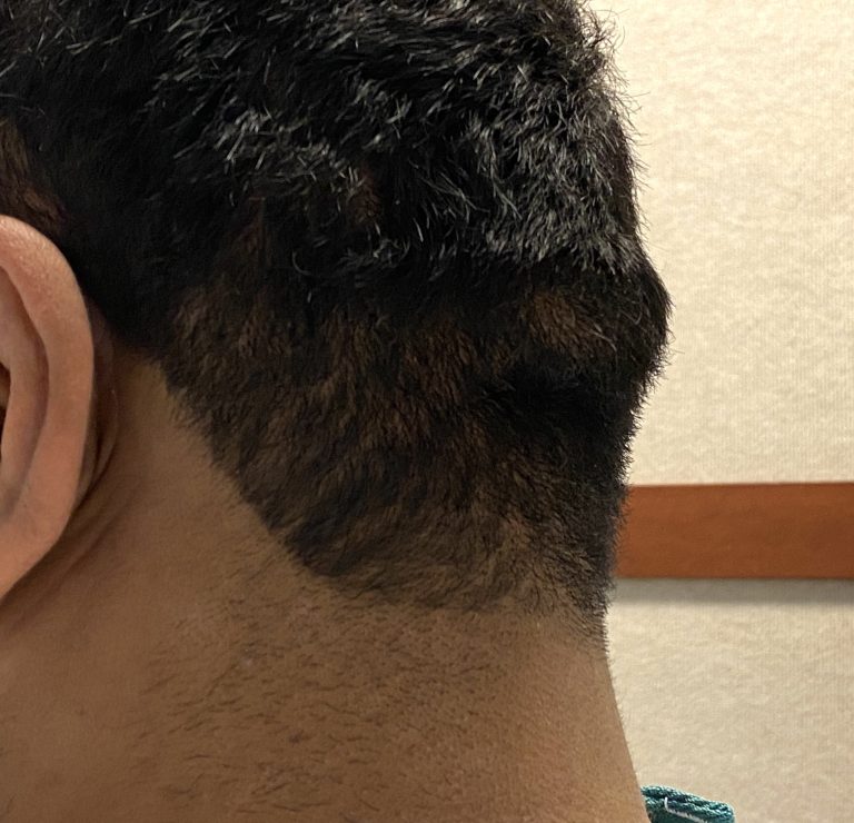 Plastic Surgery Case Study - Male Nuchal Ridge Skull Reduction with ...