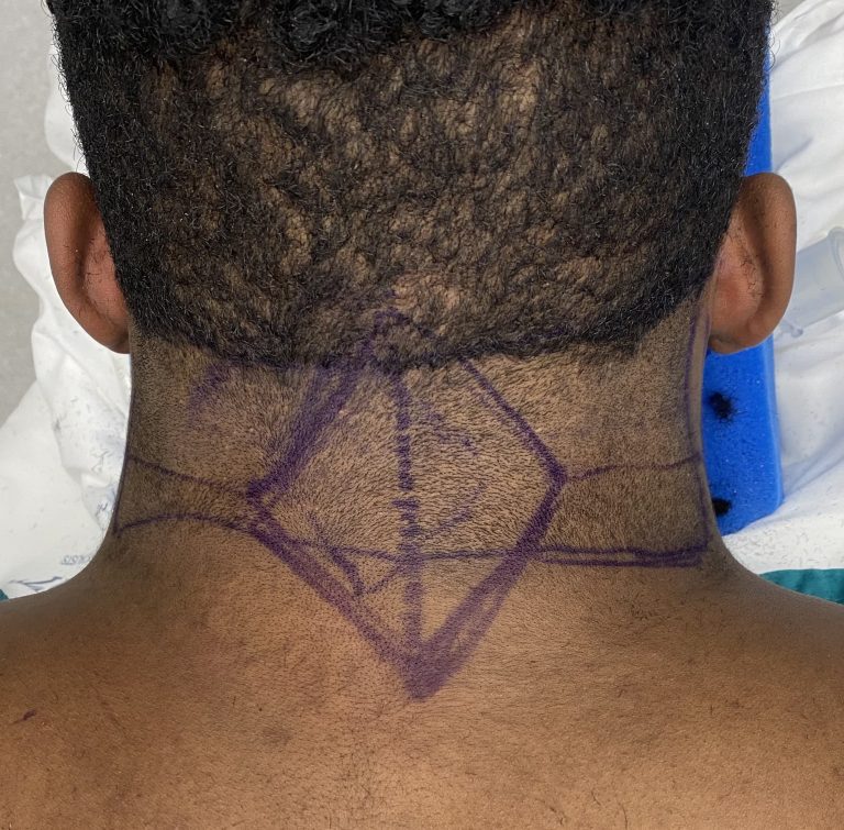 male posterior webbed neck correction markings Dr Barry Eppley ...