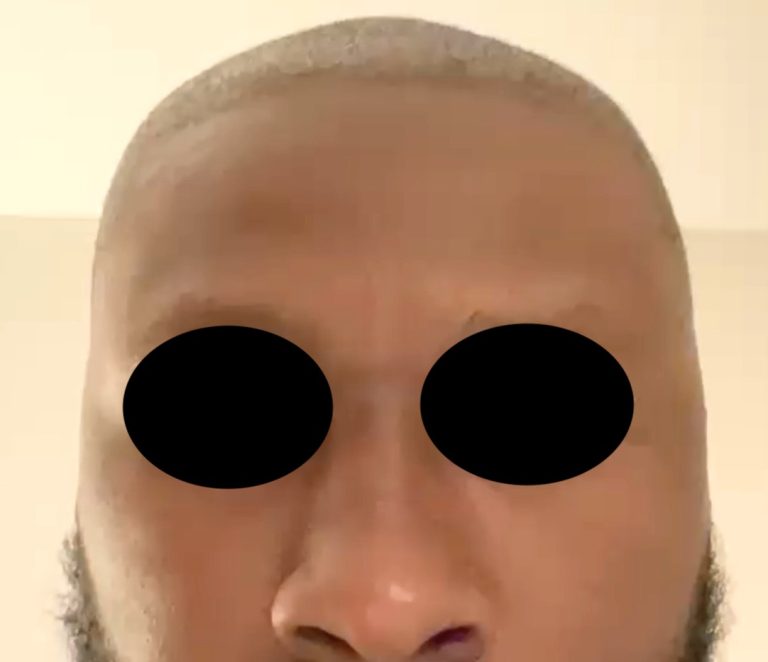 Plastic Surgery Case Study - Large Head Widening Reduction by Temporal ...