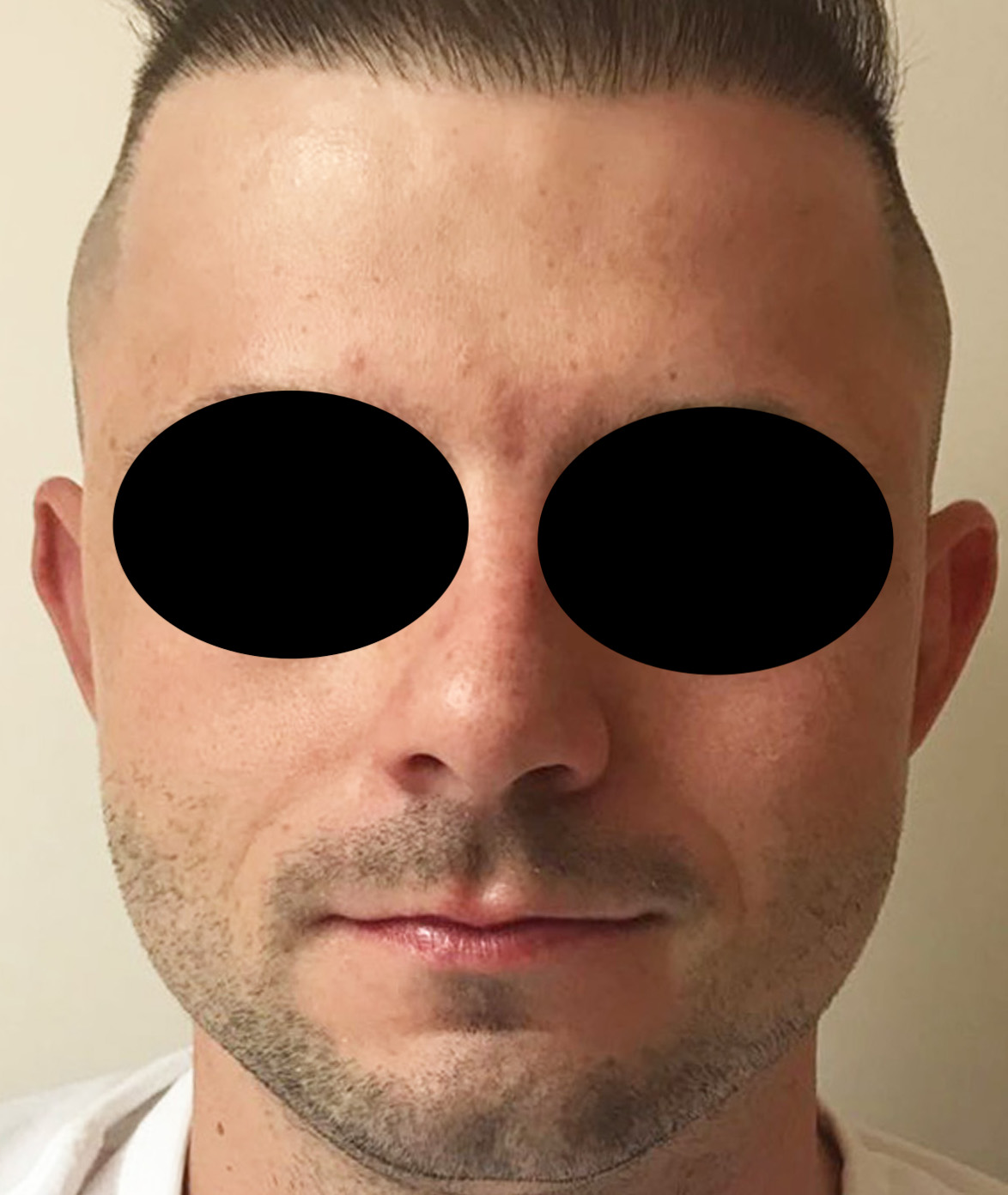 Temporal Muscle Modifications for Migraine Headache Relief - Explore ...