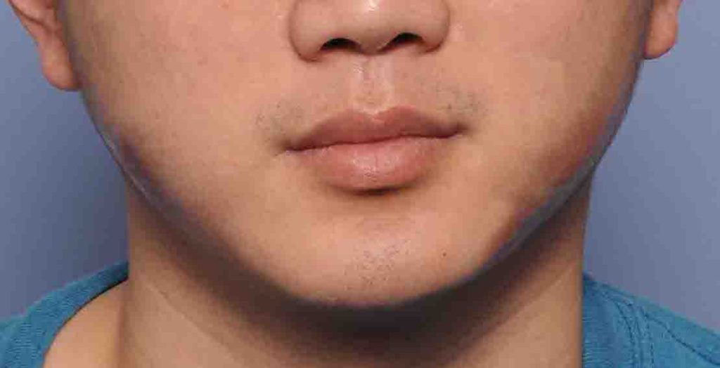 Plastic Surgery Case Study - The Use of a Modified Vertical Lengthening ...