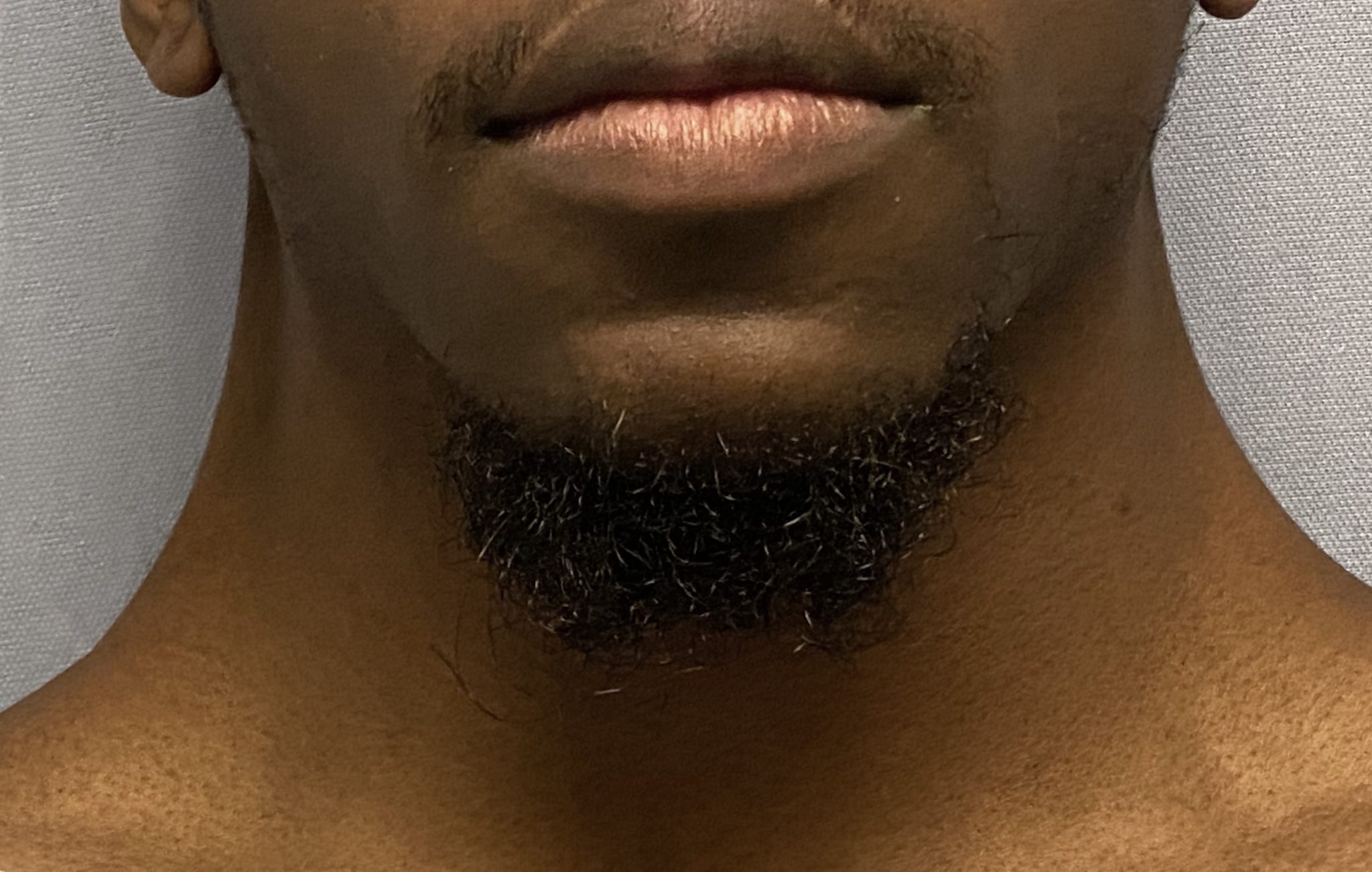 male webbed neck correction front 1 Dr Barry Eppley Indianapolis ...