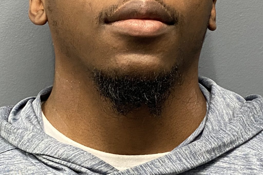 male webbed neck correction front 2 DR Barry Eppley Indianapolis ...