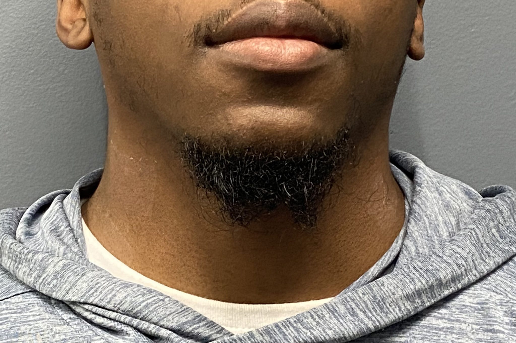 male webbed neck correction front 2 DR Barry Eppley Indianapolis ...