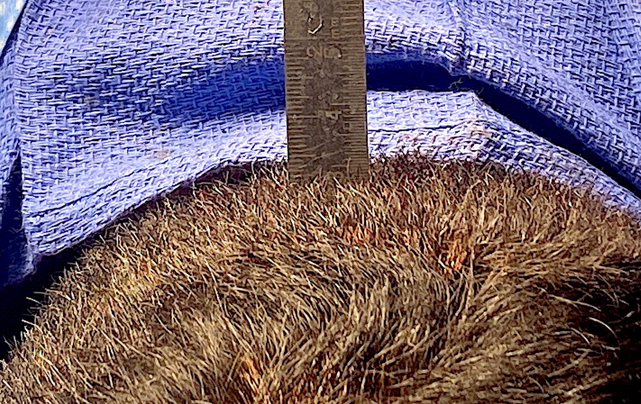 Plastic Surgery Case Study - Male Nuchal Ridge Skull Reduction with ...