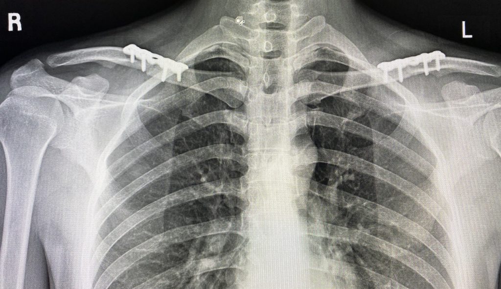 Technical Strategies - Single Plate Clavicle Reduction Fixation for ...