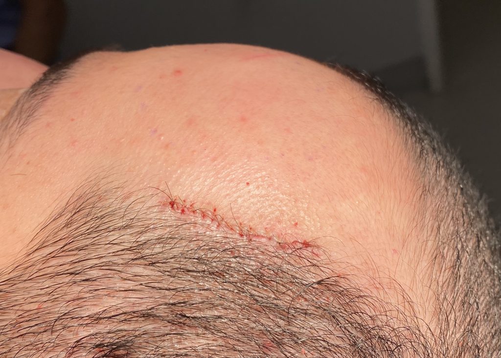 Plastic Surgery Case Study - Limited Incision Technique in Forehead ...