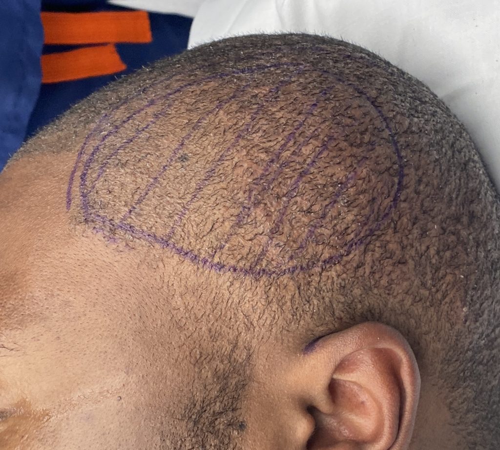 Plastic Surgery Case Study - Large Head Widening Reduction by Temporal ...