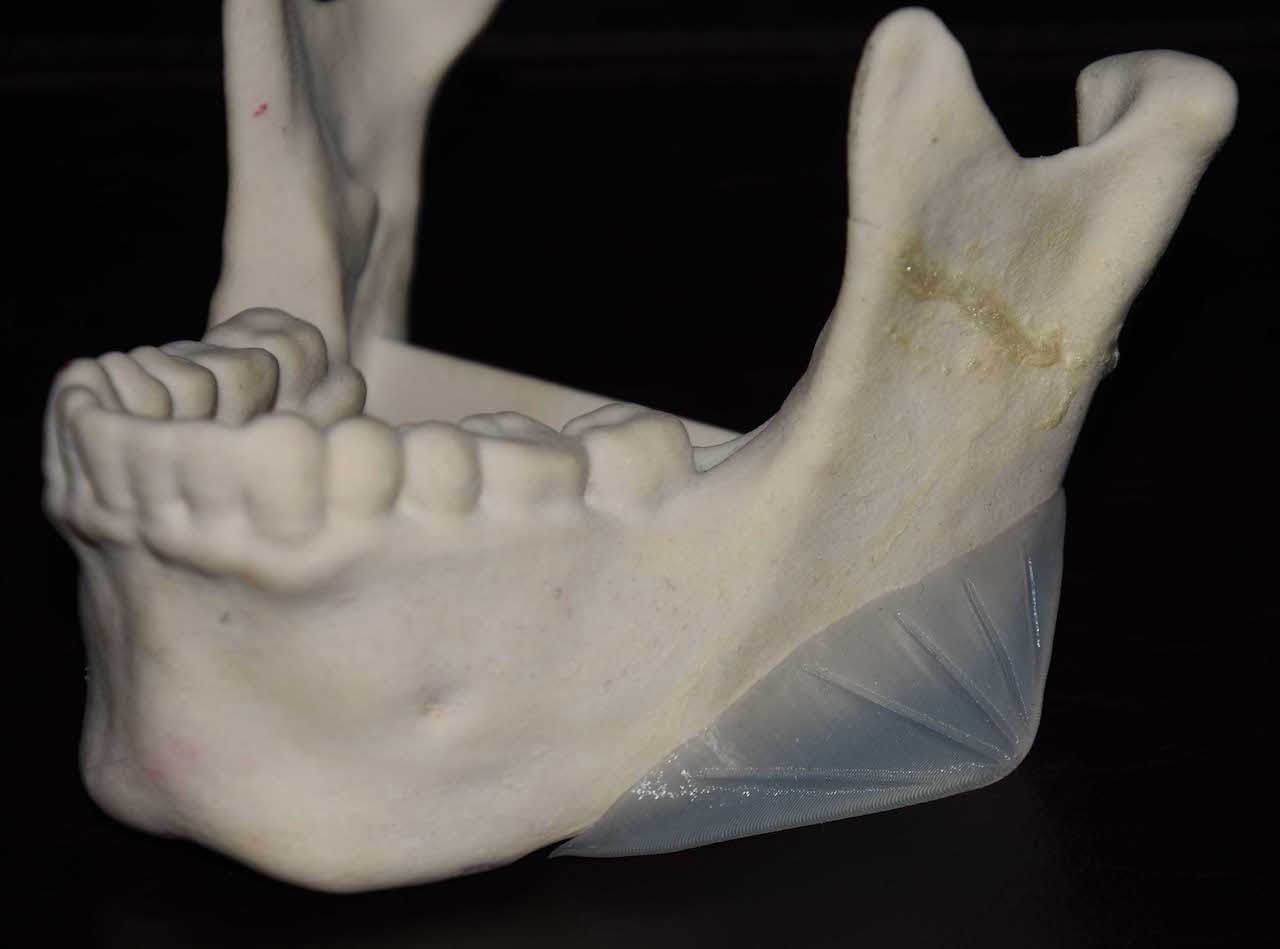 Plastic Surgery Case Study - Female Vertical Lengthening Jaw Angle ...