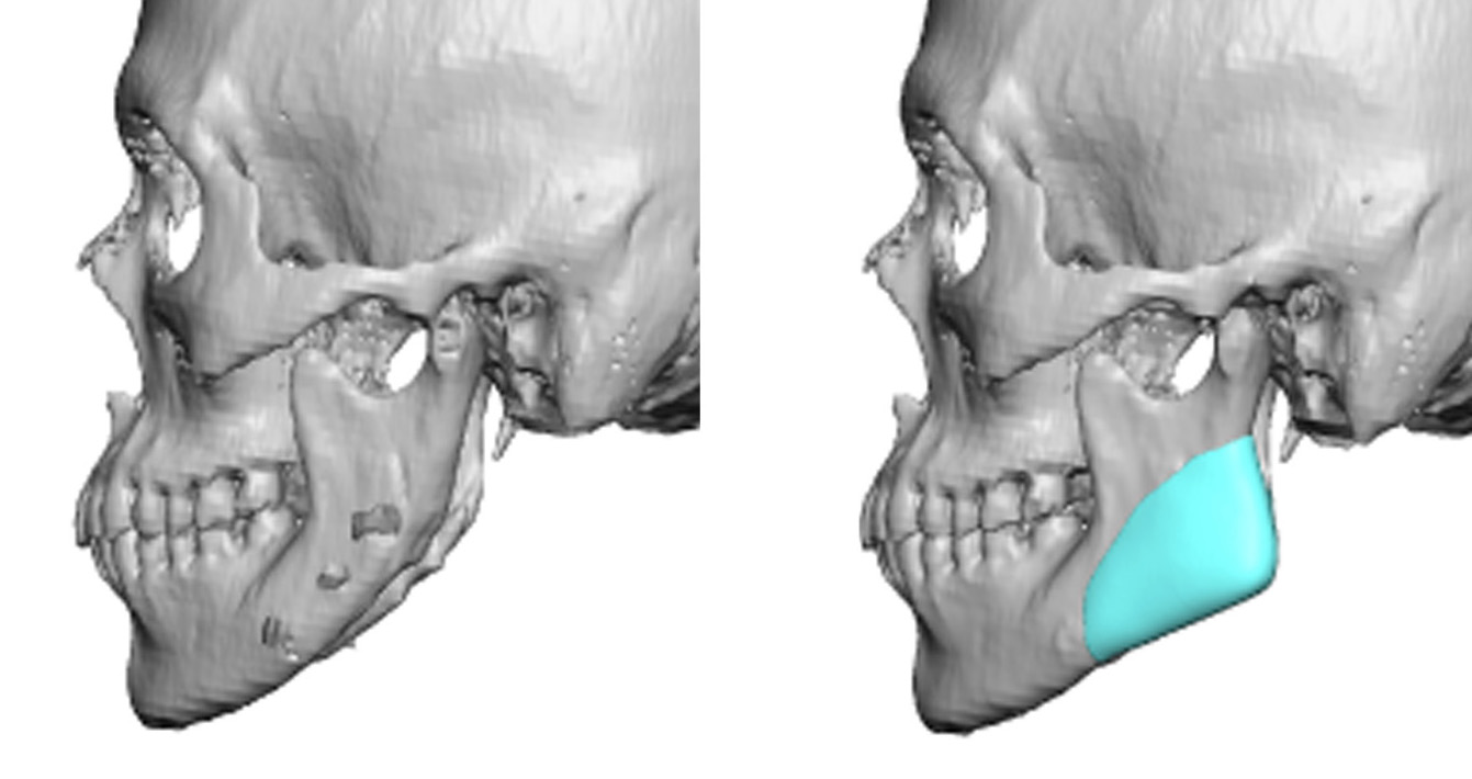 Custom Jaw Angle Implants for Jaw Angle Restoration left side Dr Barry ...