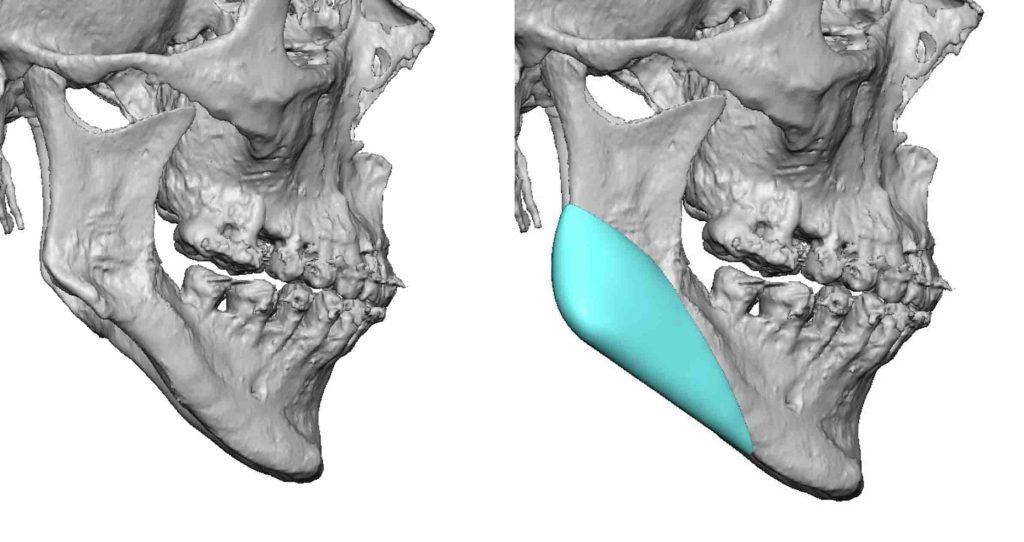 Jaw Asymmetry As An Indication For Custom Jaw Angle Implant Designs ...