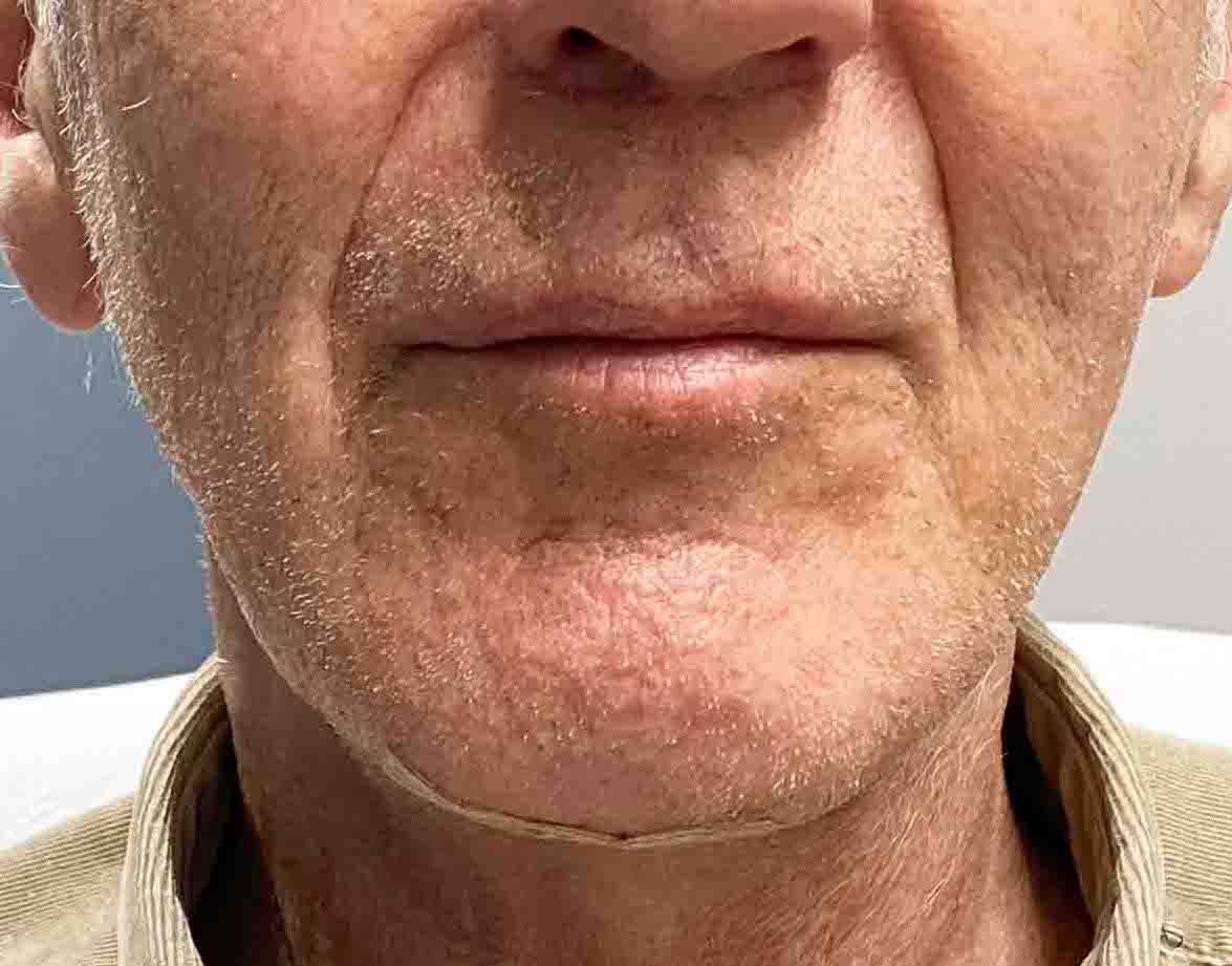 Male VLC chin implant results front view 2 Dr Barry Eppley Indianapolis ...