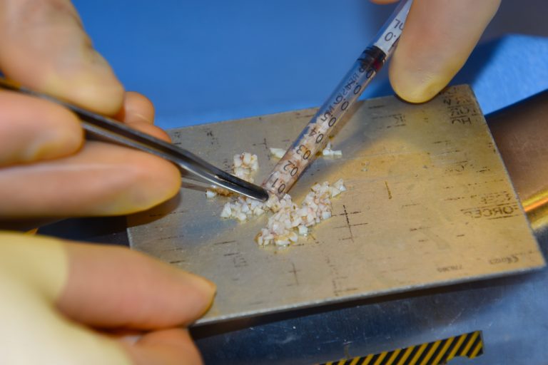 Paranasal Augmentation With Diced Rib Graft Cartilage - Explore Plastic ...