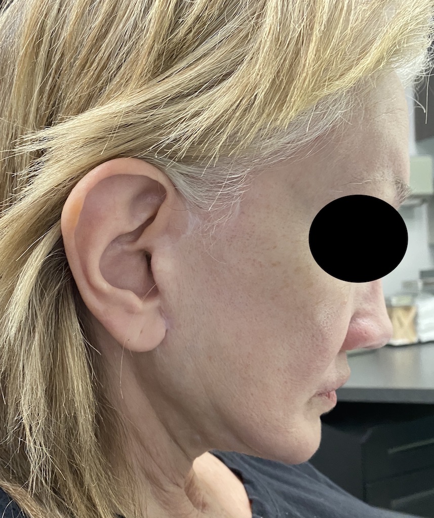 Plastic Surgery Case Study - Central Wedge Resection Technique for ...