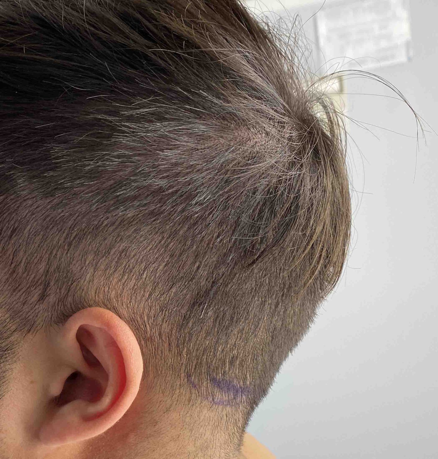 Plastic Surgery Case Study - Low Back Of The Head Augmentation With A ...