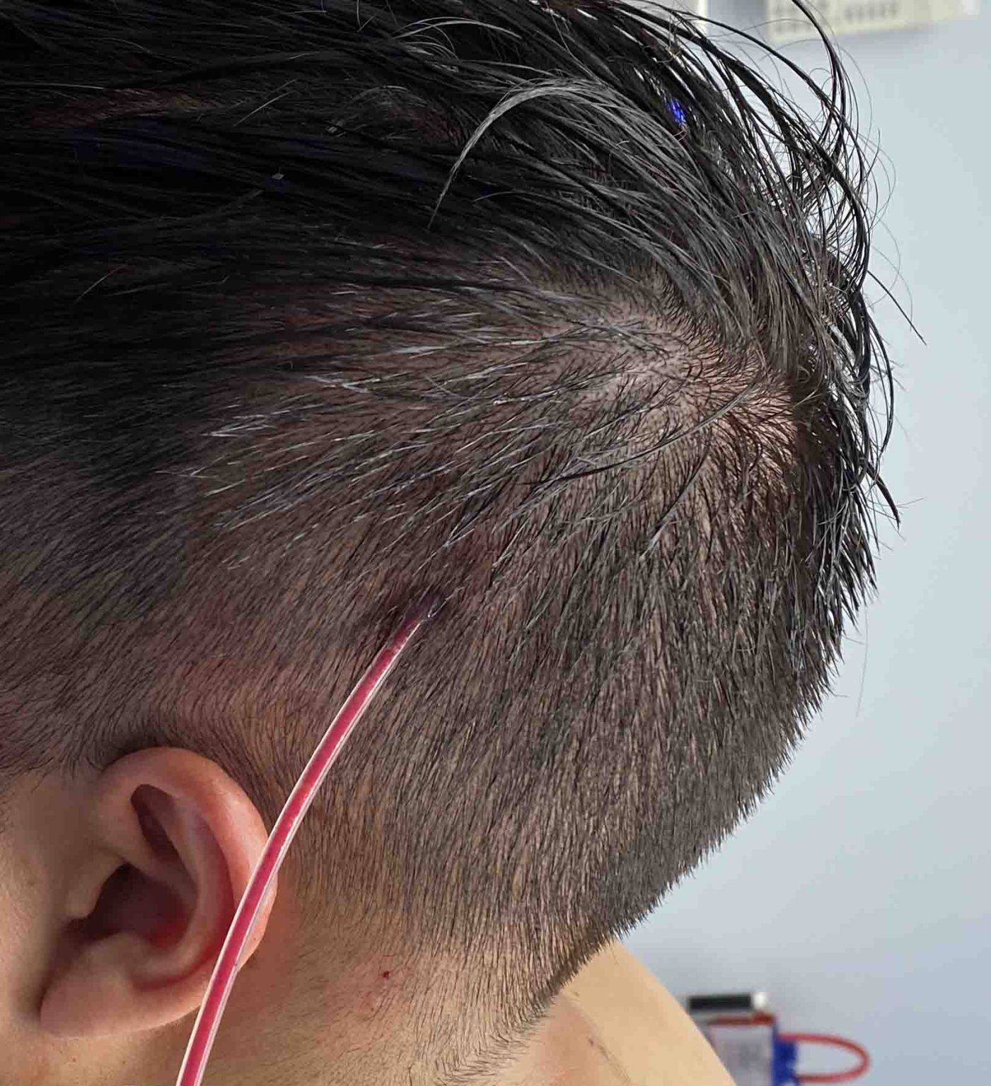 Plastic Surgery Case Study - Low Back Of The Head Augmentation With A ...