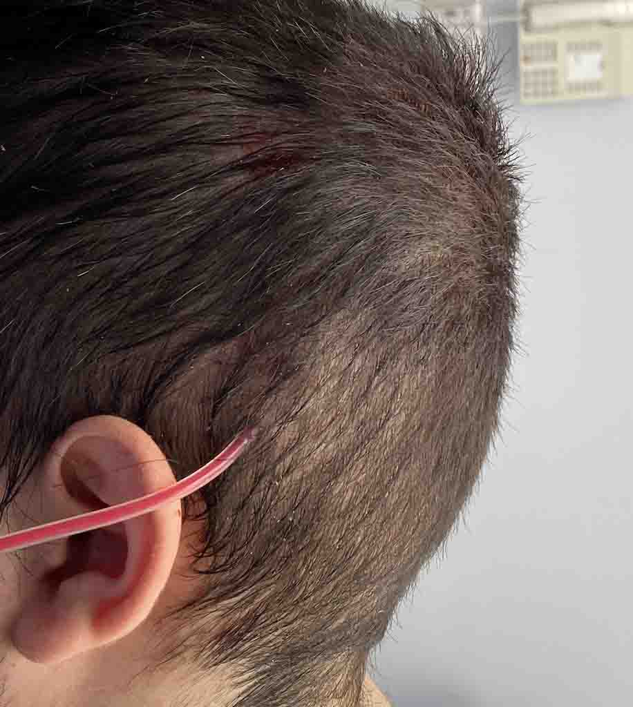 Plastic Surgery Case Study - Back Of Head Male Skull Reduction Through ...