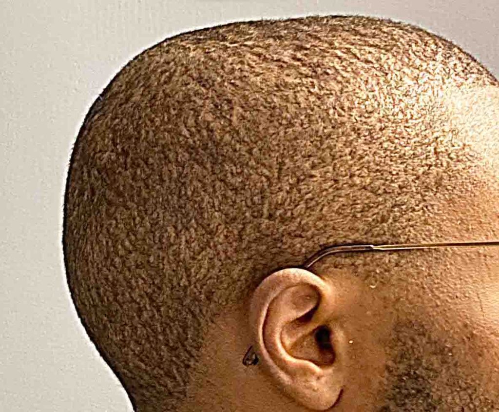 Plastic Surgery Case Study - Large Surface Area Skull Reduction with ...