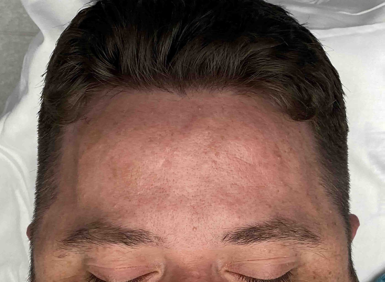 Plastic Surgery Case Study - Secondary Reduction Of An Anterior Muscle ...