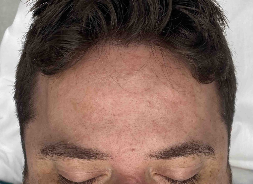 Plastic Surgery Case Study - Secondary Reduction Of An Anterior Muscle ...