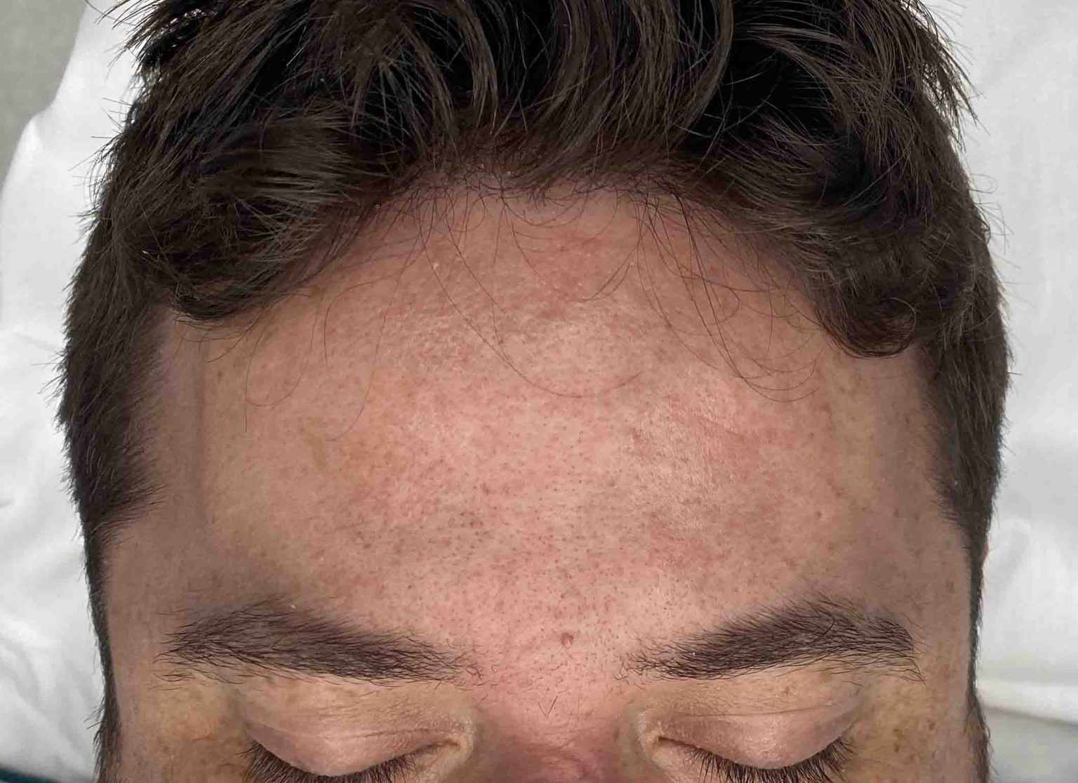 Plastic Surgery Case Study - Secondary Reduction Of An Anterior Muscle ...