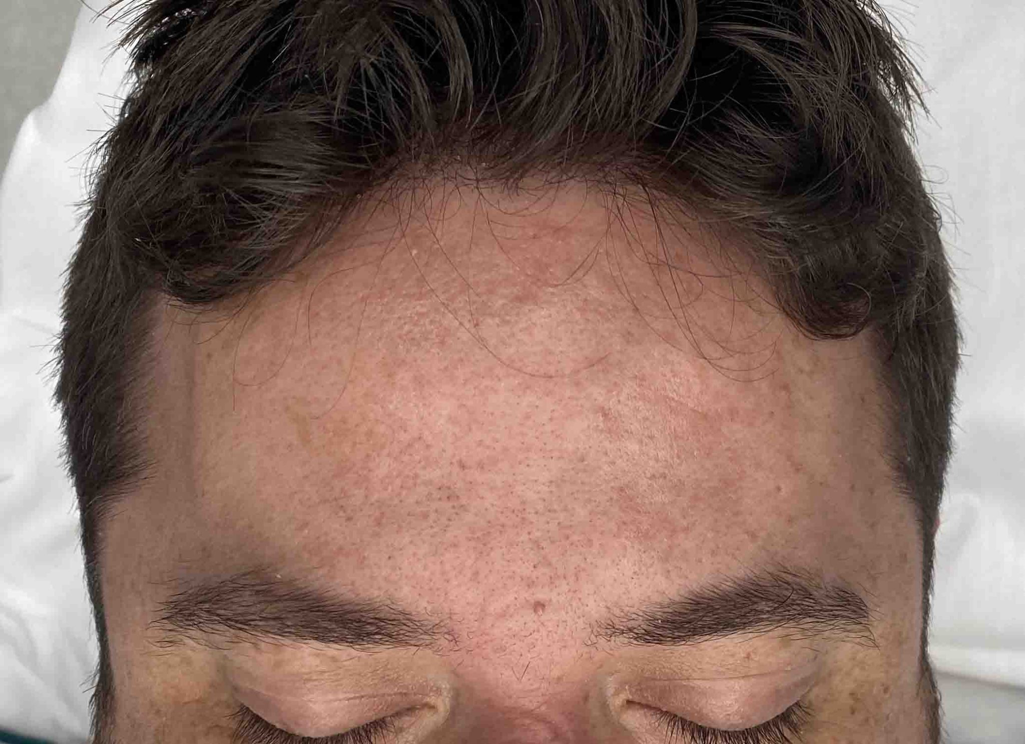 Plastic Surgery Case Study - Secondary Reduction Of An Anterior Muscle ...