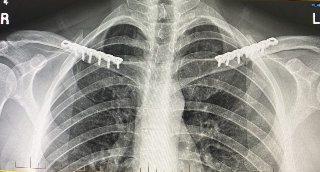 What Is The Maximal Length Of Bone That Can Be Removed In Clavicle ...