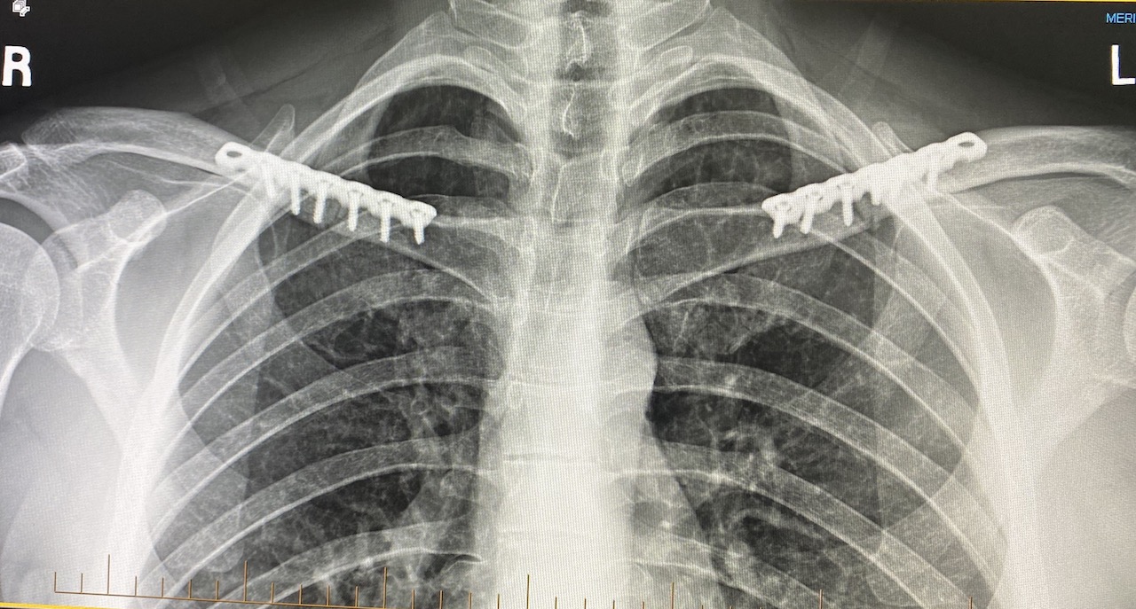 What Is The Maximal Length Of Bone That Can Be Removed In Clavicle ...