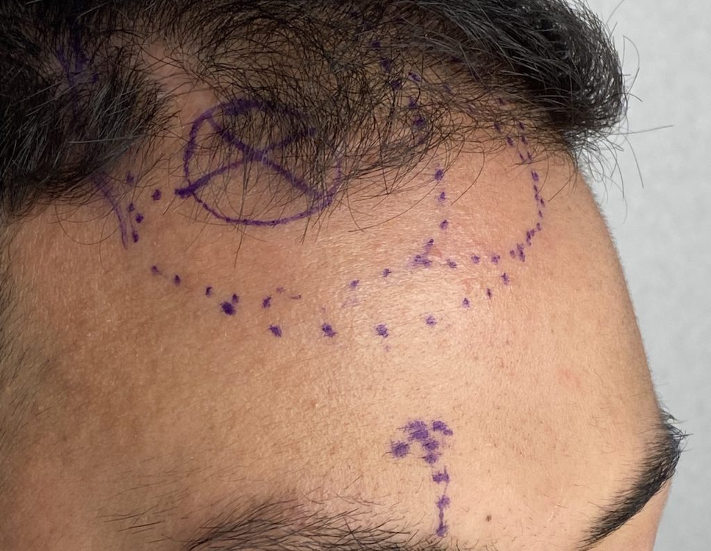 Plastic Surgery Case Study - Secondary Rasping in Bony Forehead ...