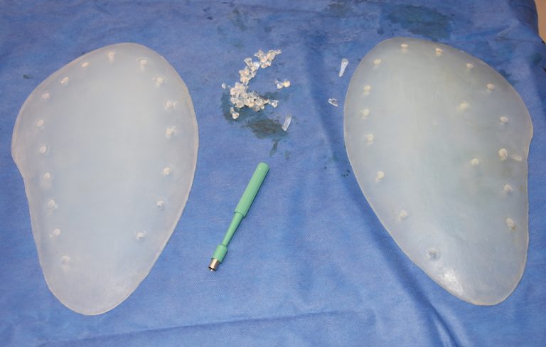 Design and Surgical Placement Concepts in Custom Hip Implants - Explore ...